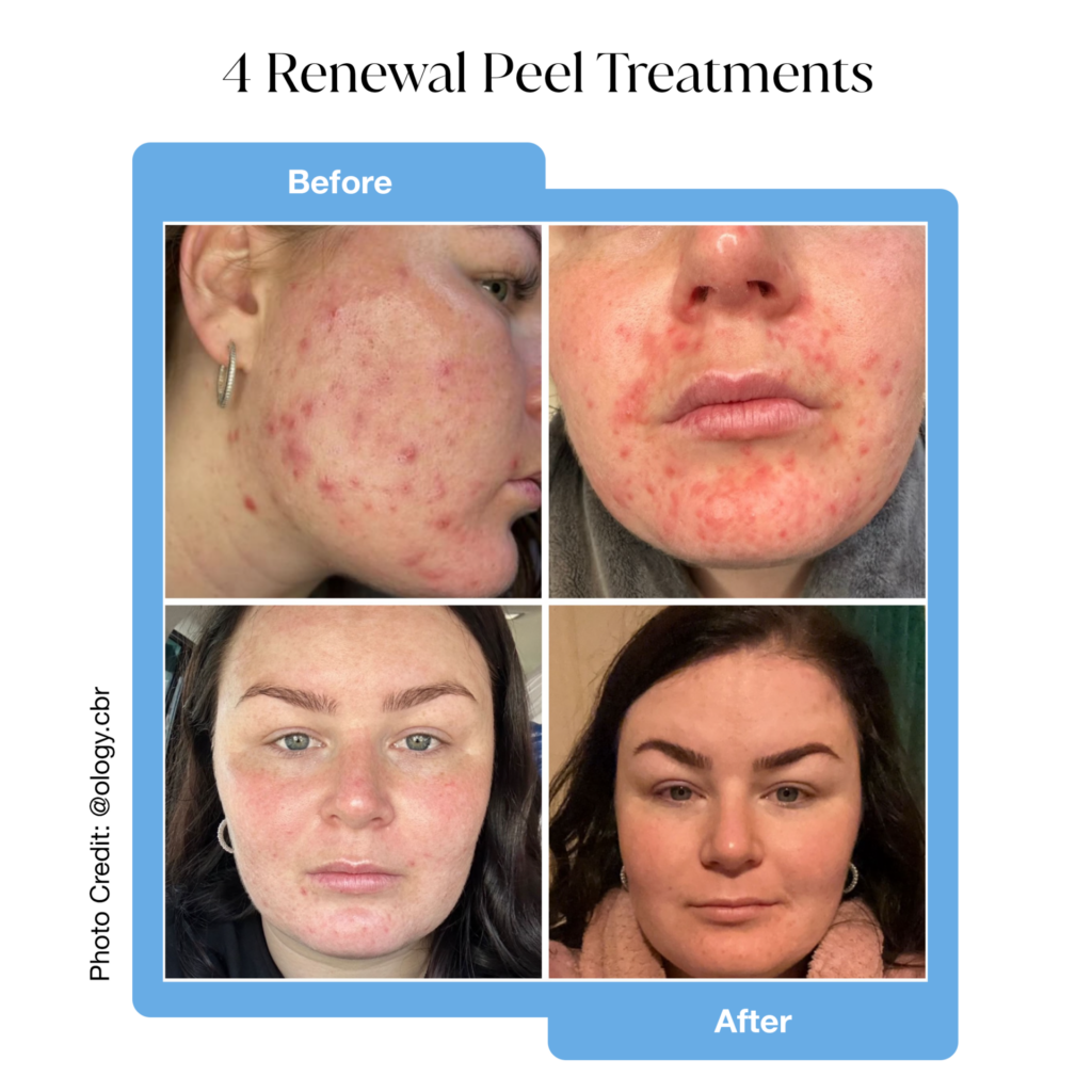 Medi Peel Treatment In Australia - Pelactiv
