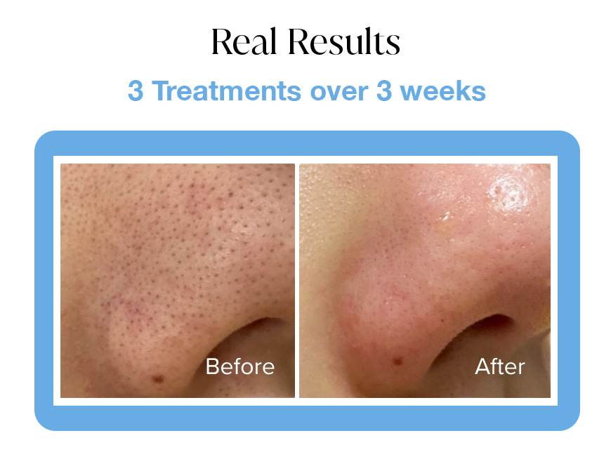 Hydra Solutions | Hydra Facial Solution Products - Pelactiv