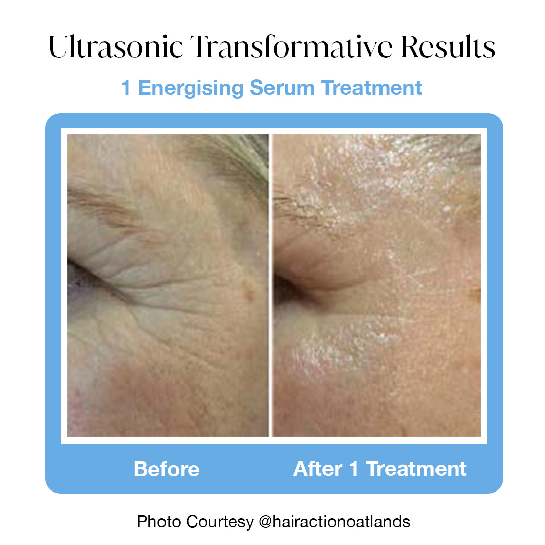 Ultrasonic Infusion Machine & Serum Products - Pelactiv